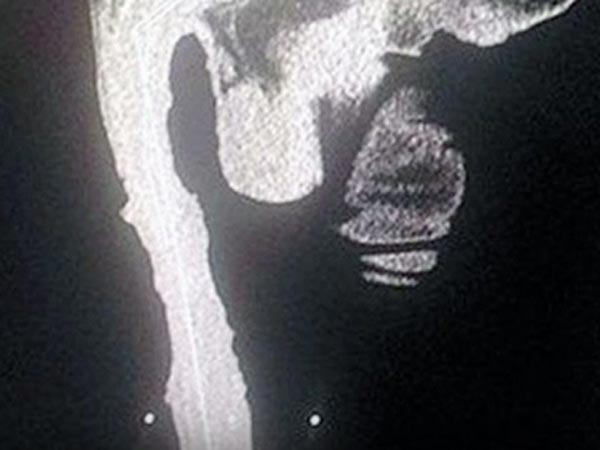 Man with world’s largest peni$