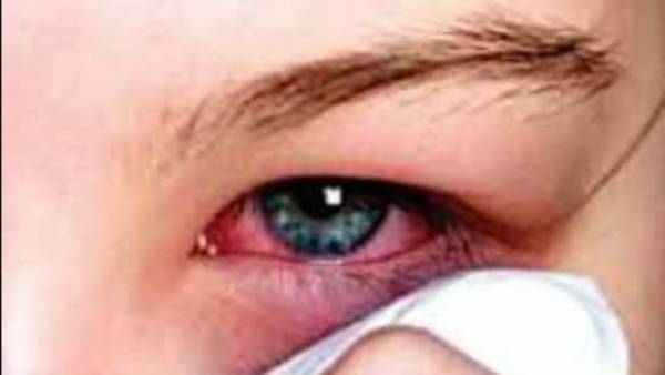 சென்னையில் அதிகரிக்கும் மெட்ராஸ் ஐ.. அறிகுறிகள் என்ன?.. எதை செய்யக் ...